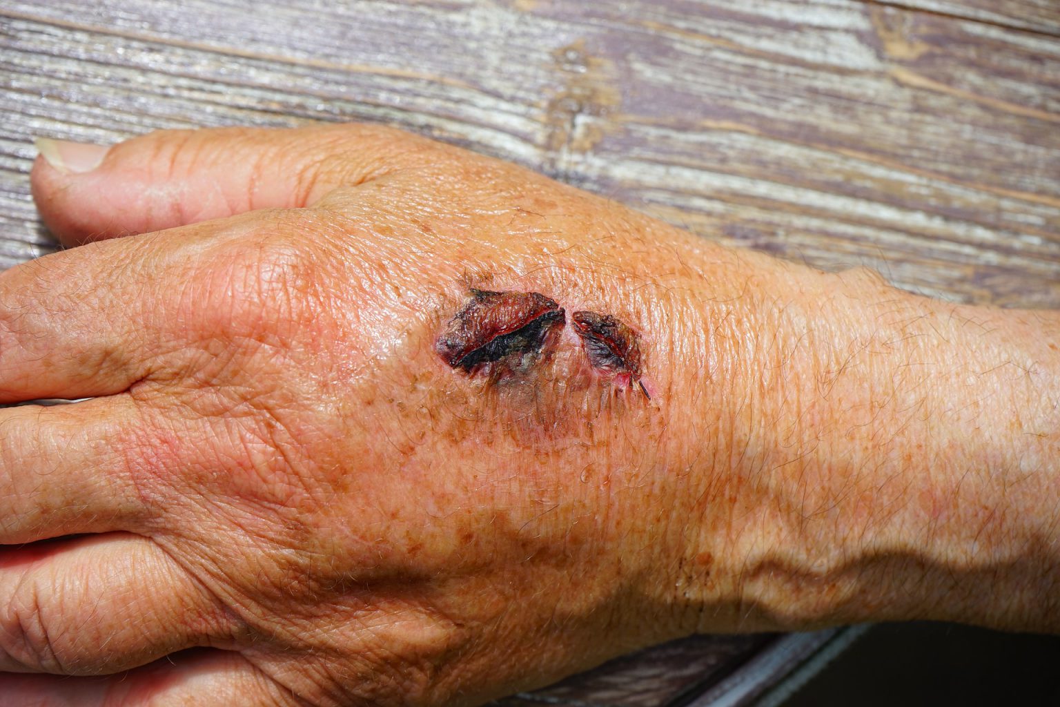 What You Need to Know About Picking on Scabs » Dose of Healthcare
